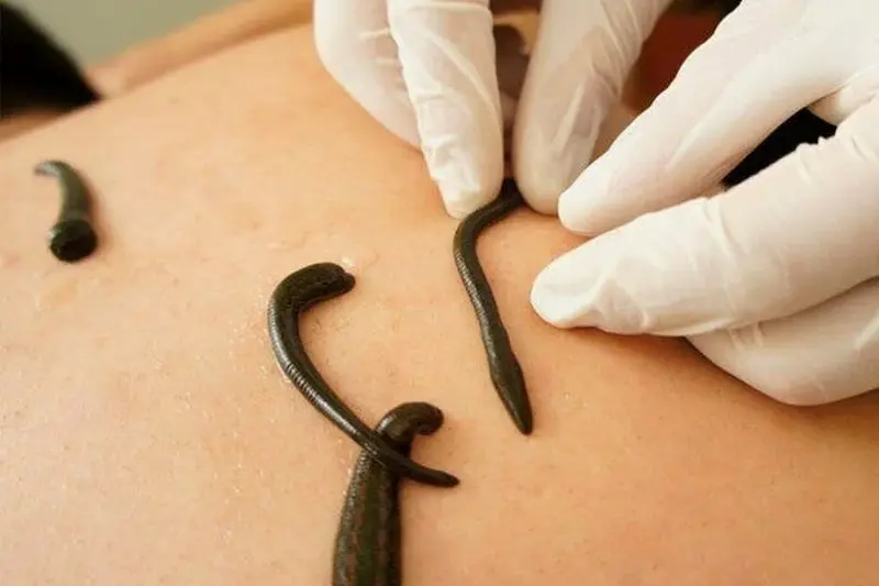 Leech Therapy On Face Jaloukavacharanam: Ayurvedic Leech Therapy For